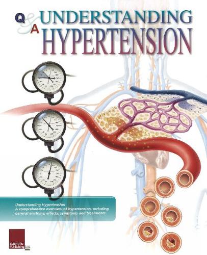 Understanding Hypertension Flip Chart by Scientific Publishing ...