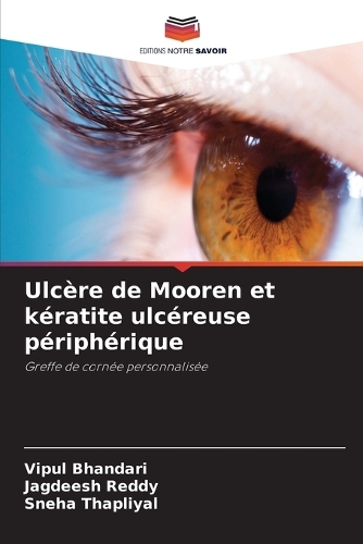 Ulcère de Mooren et kératite ulcéreuse périphérique by Vipul Bhandari ...
